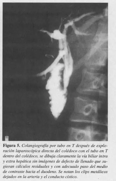 Colangiografia Trans Hepatica Percutanea