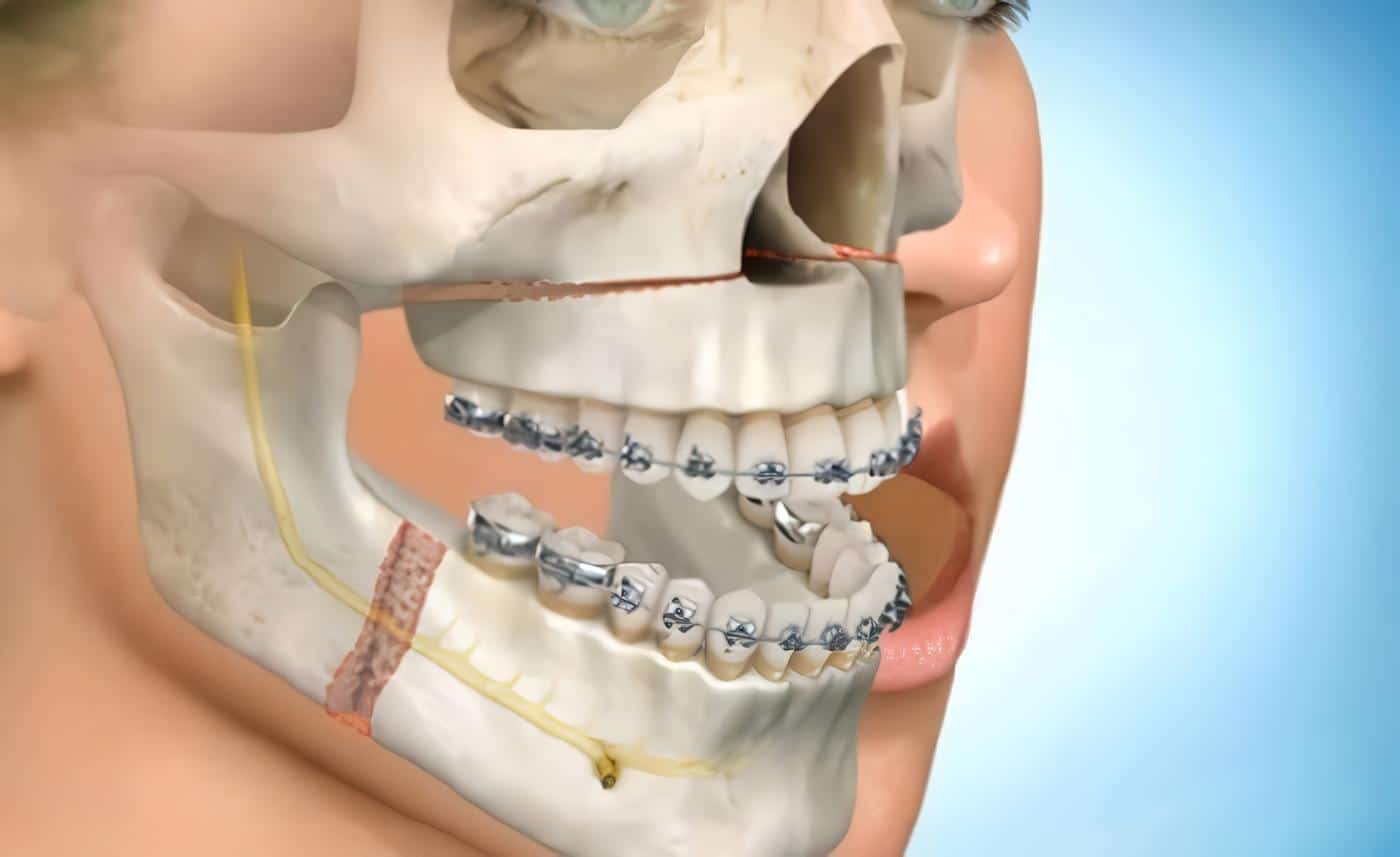 Medicamento Para La Osteoporosis, Pérdida Ósea En La Mandíbula