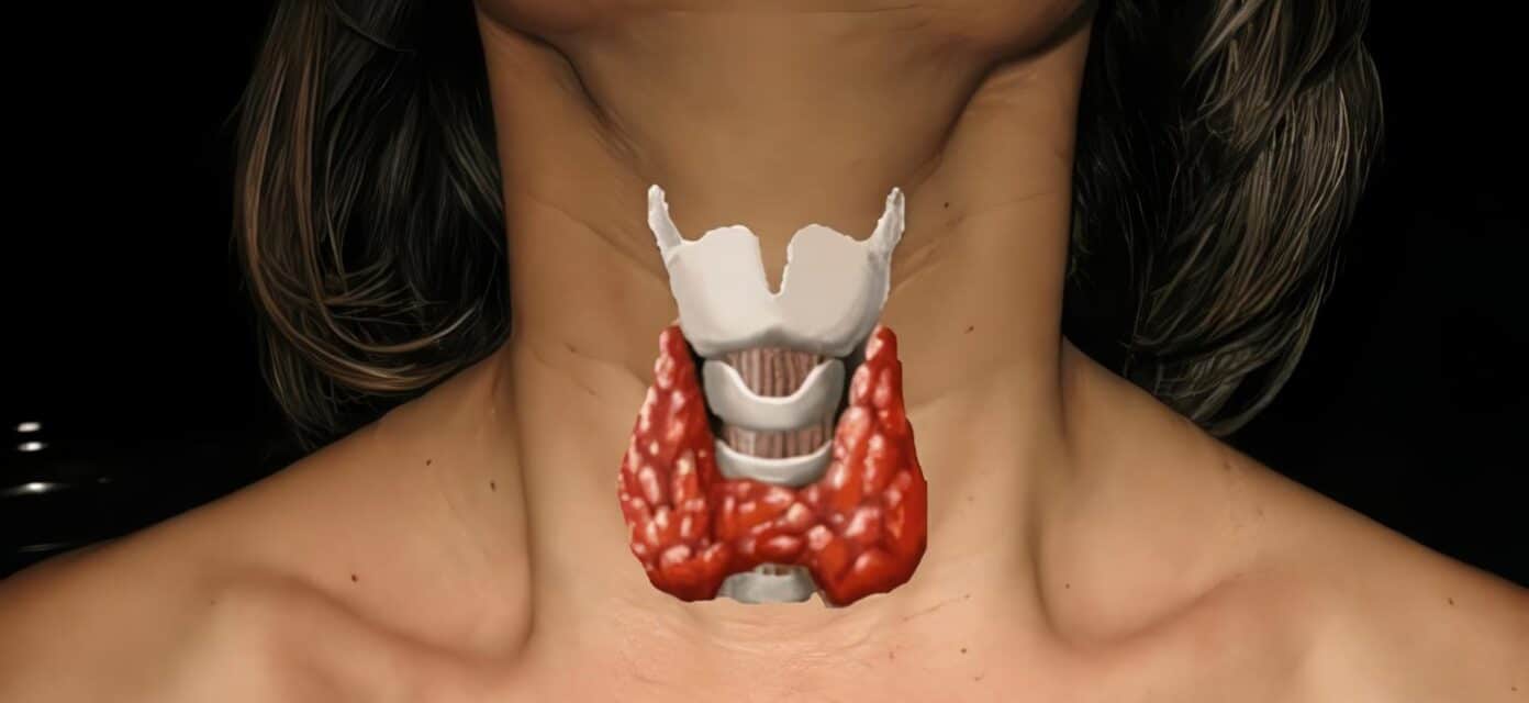 Tiroiditis Crónica, Enfermedad De Hashimoto, Guía Salud