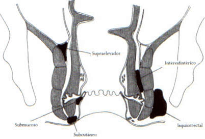 ABSCESOS ANORRECTALES, COLOPROCTOLOGÍA, GASTROENTEROLOGÍA