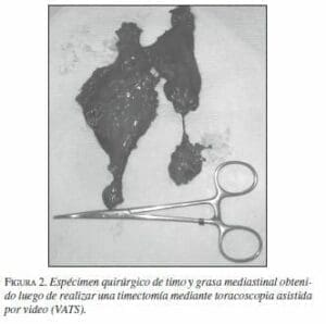 Miastenia Gravis y el Timo, Diagnóstico y Tratamiento