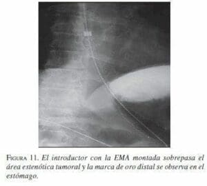 Prótesis en Esófago - Cirugía. 20 No. 1