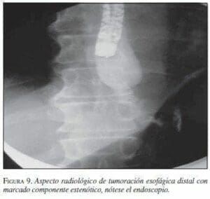 Prótesis en Esófago - Cirugía. 20 No. 1