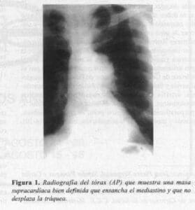 Timoma y Miastenia Gravis - Cirugía. 13 No. 4