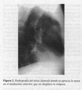 Timoma y Miastenia Gravis - Cirugía. 13 No. 4
