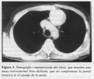Timoma y Miastenia Gravis - Cirugía. 13 No. 4