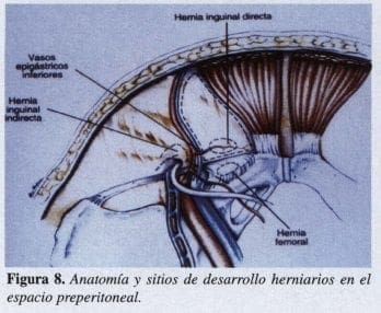 Herniorrafia Inguinal Laparascopia Técnica Quirúgica