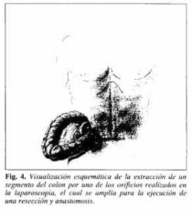 Cierre Laparoscópico de Colostomía Tipo Hartmann