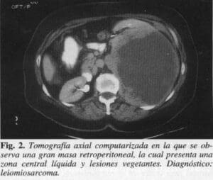 Los Sarcomas Retroperitoneales - Cirugía. 09 No. 2