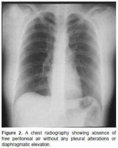 Postpolypectomy Syndrome, Revista De Cirugía