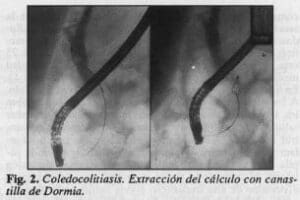 Esfinterotomía Biliar Endoscópica - Cirugía. 07 No. 1 Especial