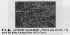 Patología del confluente biliopancreatico, Estudio histológico