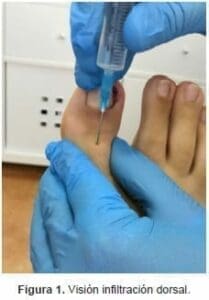 Onicocriptosis, Técnica En V Invertida,primer Dedo Del Pie