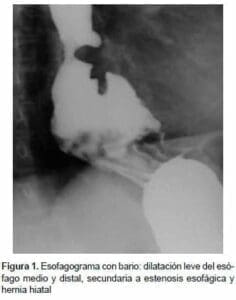 Esófago Corto, Herniorrafia Hiatal Y Fundoplicatura