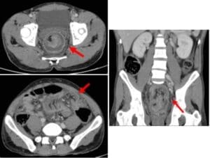 Invaginación Sigmoidea | Reducción Endoscópica Preoperatoria