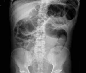 Invaginación Sigmoidea | Reducción Endoscópica Preoperatoria