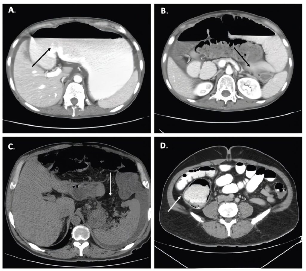 Obstrucción Intestinal por Adherencias | Adherencias Tisulares