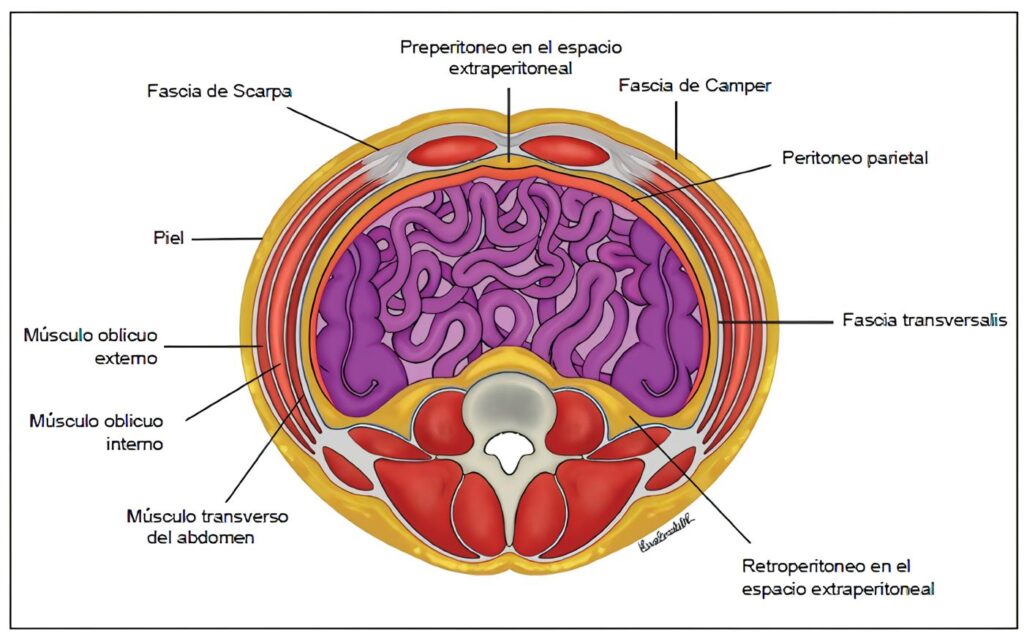 Espacio Extraperitoneal | Abordajes Quirúrgicos | Hernia Inguinal