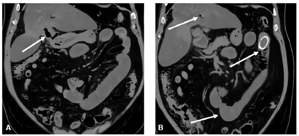 Diagnóstico de Íleo Biliar | Obstrucción Intestinal | Fístula Biliar