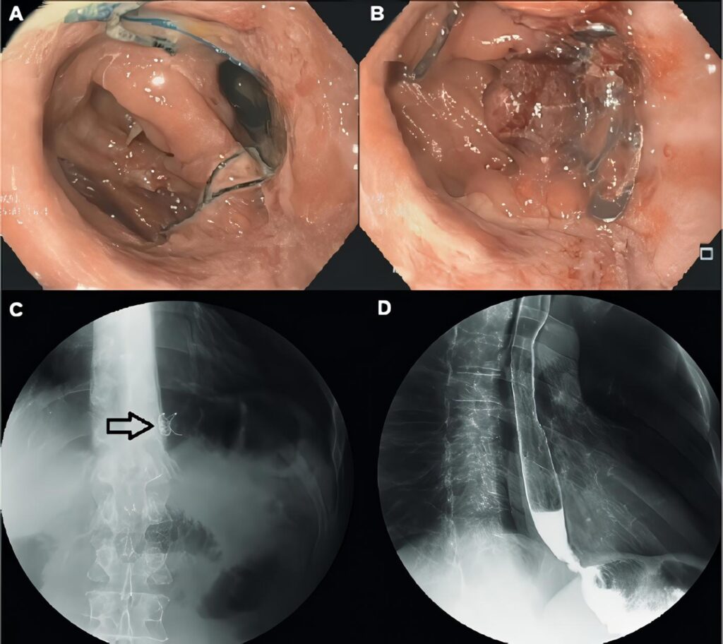 Tracto Gastrointestinal con Clip | Fuga Anastomótica | Fístula