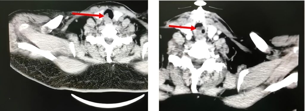 Tumor Glómico | Neoplasias de la Tráquea | Inmunohistoquímica