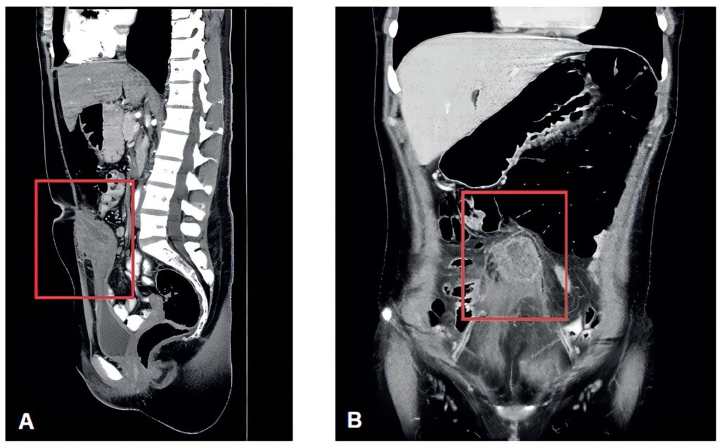Persistencia de Uraco | Anomalías Congénitas | Dolor Abdominal