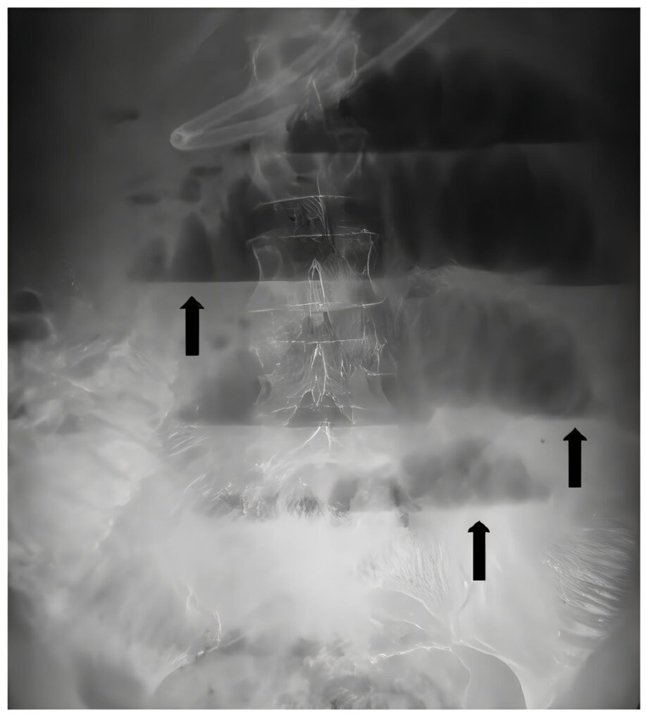 Hernia Obturadora Secundaria | Obstrucción Intestinal Secundaria