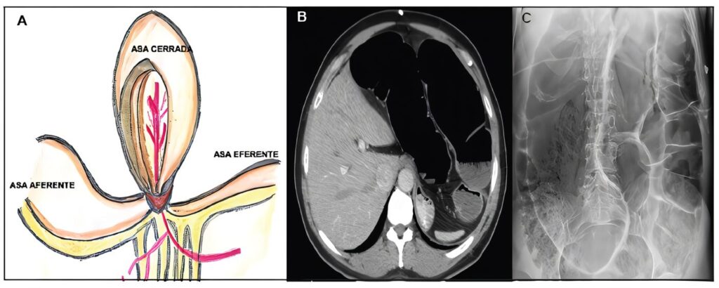 Obstrucción Intestinal por Adherencias | Adherencias Tisulares
