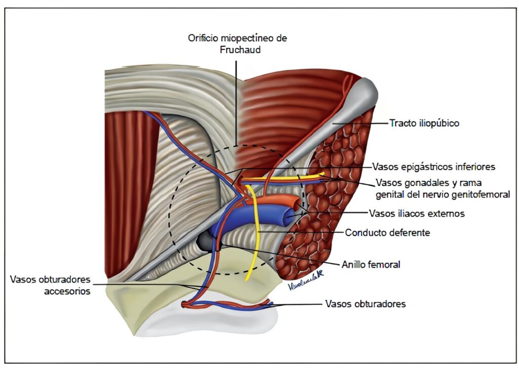 Espacio Extraperitoneal | Abordajes Quirúrgicos | Hernia Inguinal