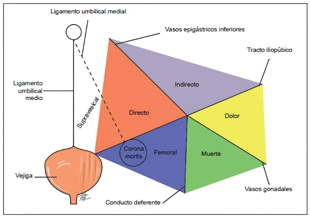 Espacio Extraperitoneal | Abordajes Quirúrgicos | Hernia Inguinal