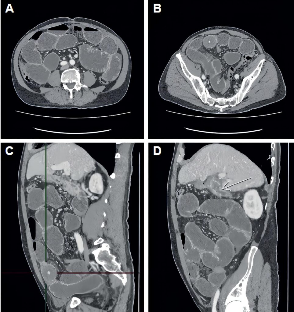 Obstrucción Intestinal a Causa de Íleo Biliar | Sistema Digestivo