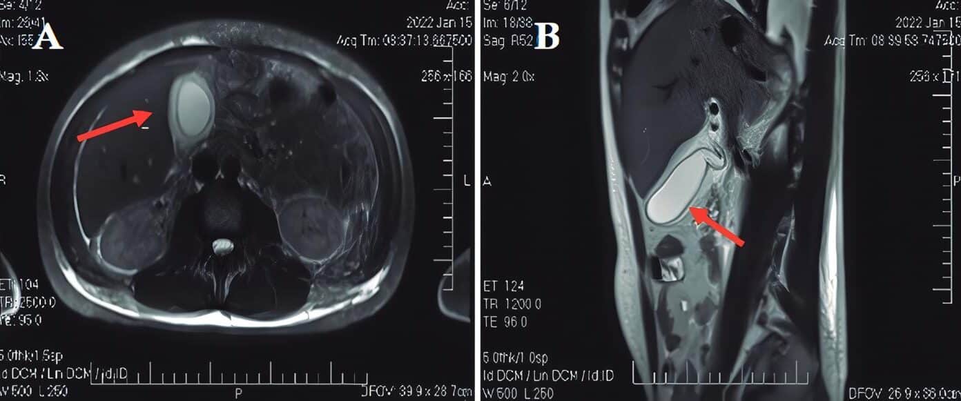 Acalculous Cholecystitis and Covid-19 | Colecistitis Acalculosa