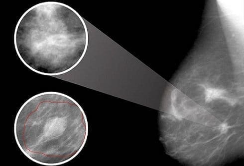 Medicamento Contra El Cáncer Inflamatorio De Mama, Noticias